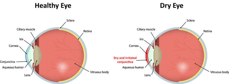 Dry Eye - Berg Eye